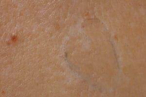 Keratosis Removal - Laser Treatments in Surrey, BC