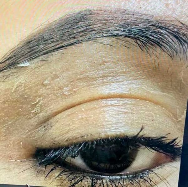 Eye Peel | Intense Treatment - Ageless Beauty Laser & Spa